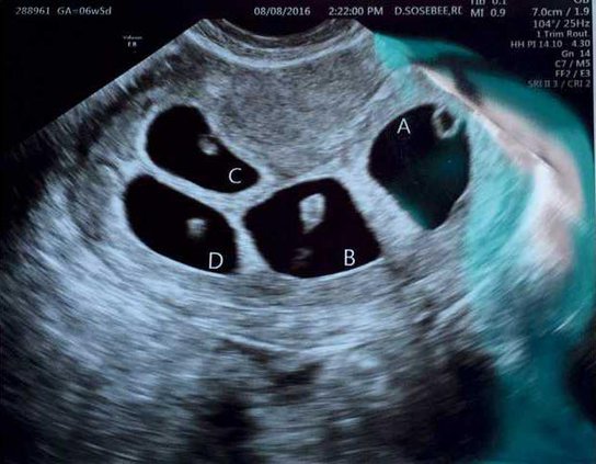quadruplets scan