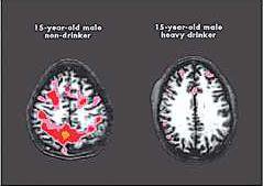 Lifetime of ill effects: Drugs can stunt brain growth - Gainesville Times